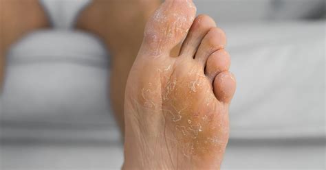Athletes Foot Treatments Causes And Symptoms Cls Health