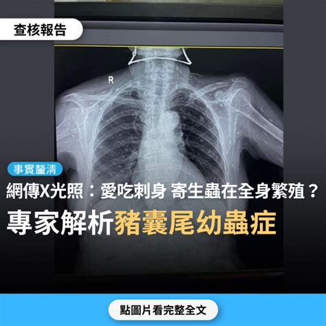 【事實釐清】網傳白點x光照片「來自泰國，這女生很愛吃刺身，寄生蟲已在體內繁殖死亡後鈣化而成溫馨提示生的肉食海鮮別吃太多