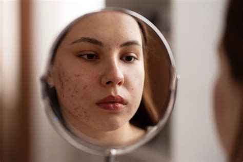 REMOVE DARK SPOTS CAUSED BY PIMPLES A STEP BY STEP GUIDE ANNVIO