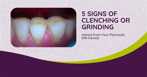 The Top 5 Signs That You Clench Or Grind Your Teeth Dentist Plymouth