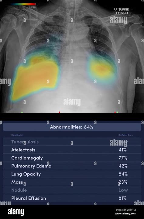 Chest X Ray Image With Ai Artificial Intelligence Report Stock