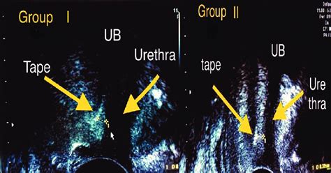 Left Translabial Ultrasound Image Showing The Distance Between The Download Scientific