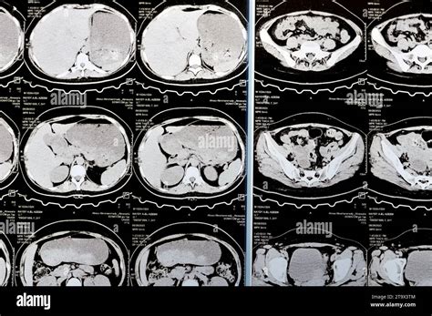 Cairo Egypt October 3 2023 Multi Slice Ct Scan Abdomen And Pelvis
