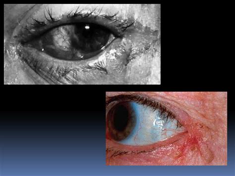 Angular Blepharoconjunctivitis