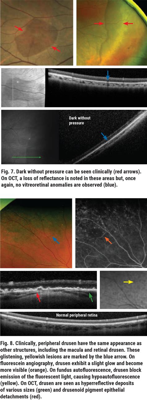 Navigating The Retinal Periphery