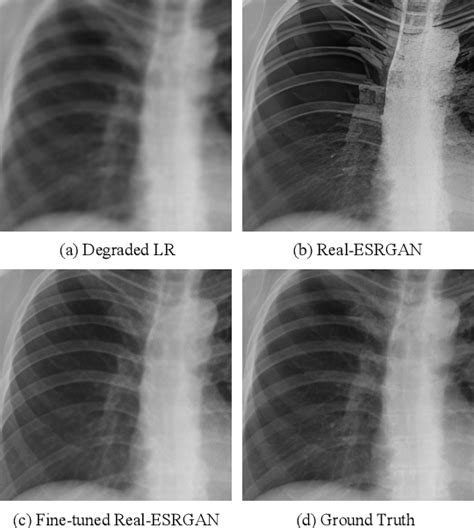 Figure From Fine Tuned Generative Adversarial Network Based Model For Medical Image Super