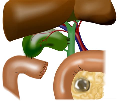 Hepaticocholecystoenterostomy As An Alternative To Hepaticojejunostomy For Biliary Bypass The