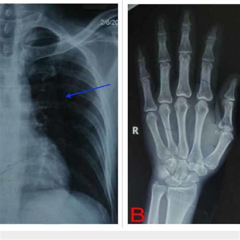 Radiographs A Chest X Ray Showing Hyperlucency On The Left Side With Download Scientific