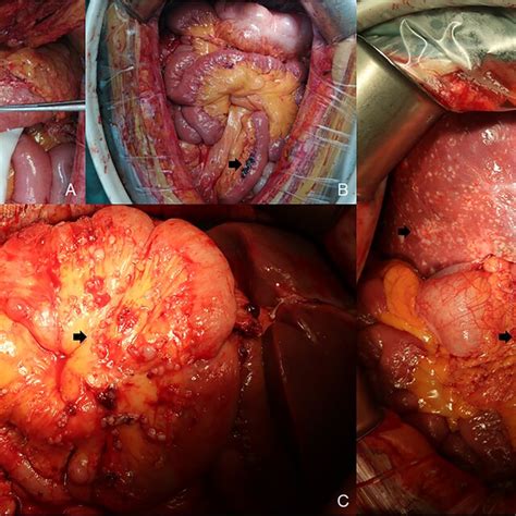 A And B Show Mesenteric Metastases And R01 Crs C And D Show