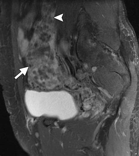 Extrauterine Choriocarcinoma Another Uncommon Primary Pelvic Retroperitoneal Mass Seen In