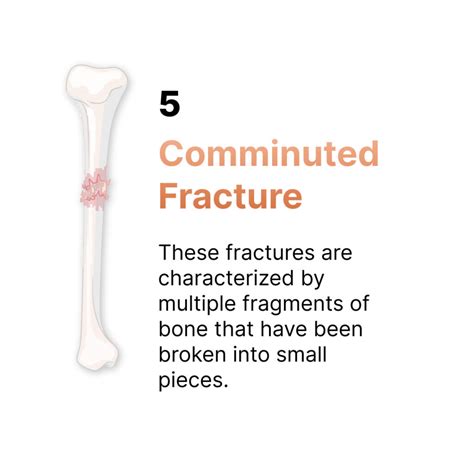 7 Types Of Bone Fractures Orthopaedic Surgeon Durban
