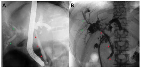 Ercp And Postoperative T Tube Cholangiography A Ercp Showing An Download Scientific Diagram