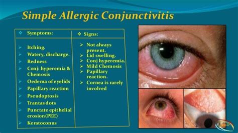 Conjunctivitis