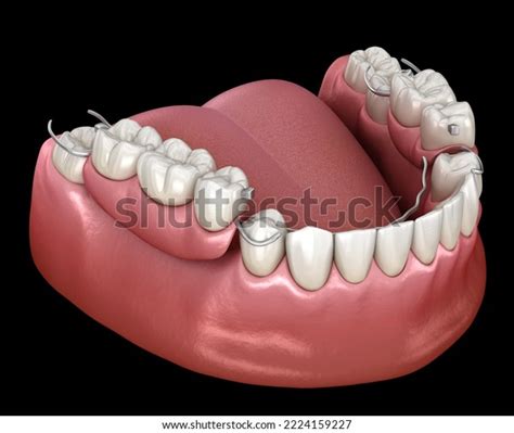 Mandibular Partial Denture