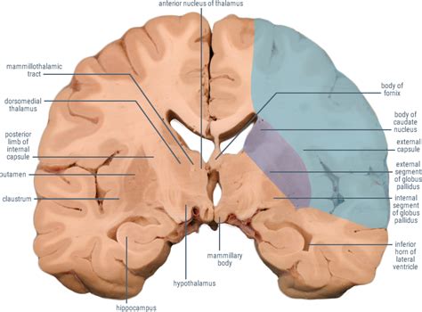 Middle Cerebral Artery Stroke