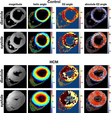 Magnitude Helix Angle And Secondary Eigenvector Orientation Maps