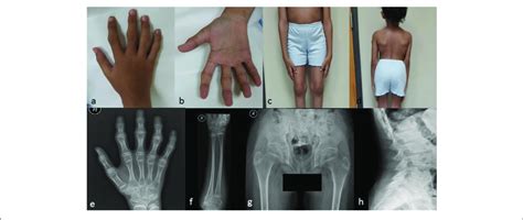 Clinical Pictures Of The Patient Iv 4 A Showing Camptodactyly Of