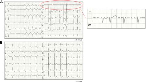 Usefulness Of Omnipolar Technology Near Field For Accessory Pathway