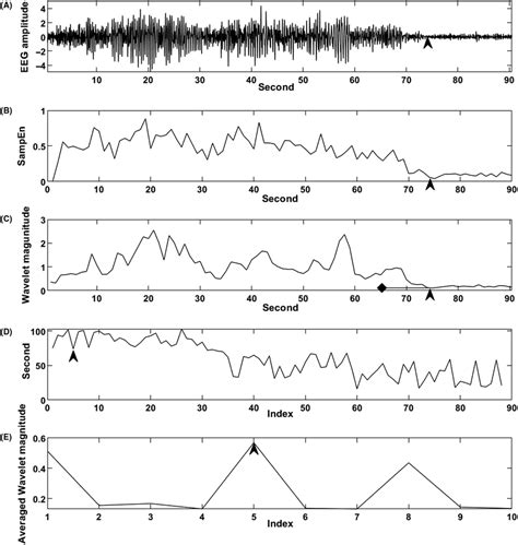 A Electroconvulsive Therapy Ect ‐induced Eeg Seizure For Which The