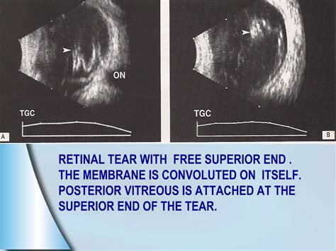B SCAN PPT Eye And Vision Conditions Diseases And Conditions