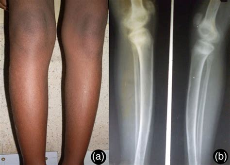 Image Shows Bilateral Genu Valgum Deformity Of Patient A And X Ray Download Scientific
