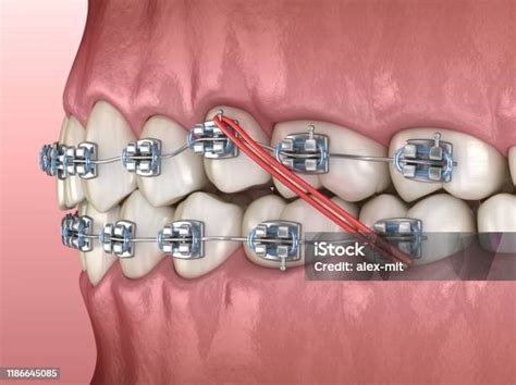 보정 치과 물린 탄성 및 금속 중괄호 의학적으로 정확한 치과 3d 일러스트레이션 개선에 대한 스톡 사진 및 기타 이미지 개선 금속 도예 Istock