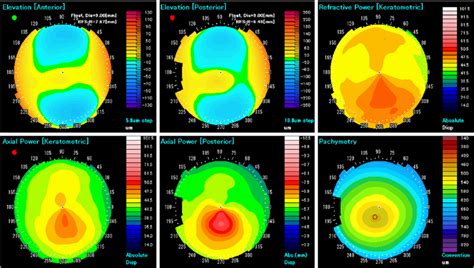 Representative Example Of 6 Color Coded Maps Anterior Elevation Representative Example Of 6 Color Coded Maps Anterior Elevation