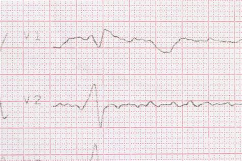 Bloqueio Ramo Esquerdo Ecg Retoedu