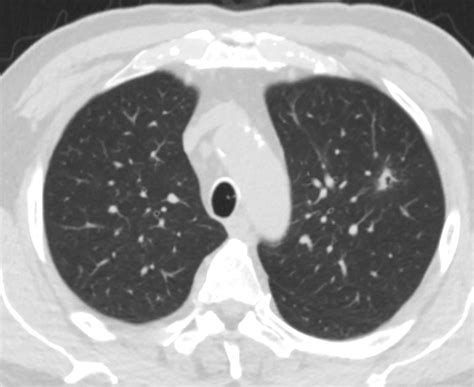 Map Nodules And Masses Cavitating Links On Web The Common Vein