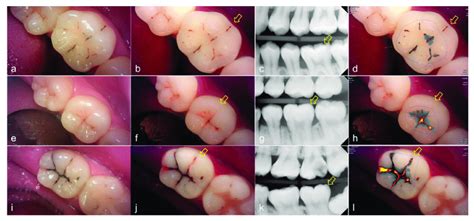 Occlusal Dental Caries A D Qlf Caries Score 1 Fluorescence Loss And Download Scientific
