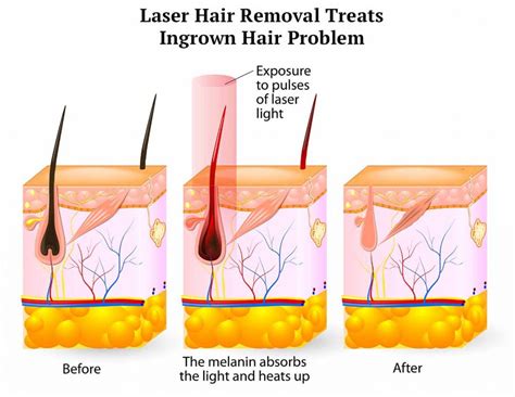 Ingrown Pubic Hair Treating And Preventing With Laser