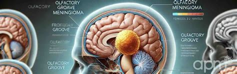 Your Joomla Site Olfactory Groove Meningioma