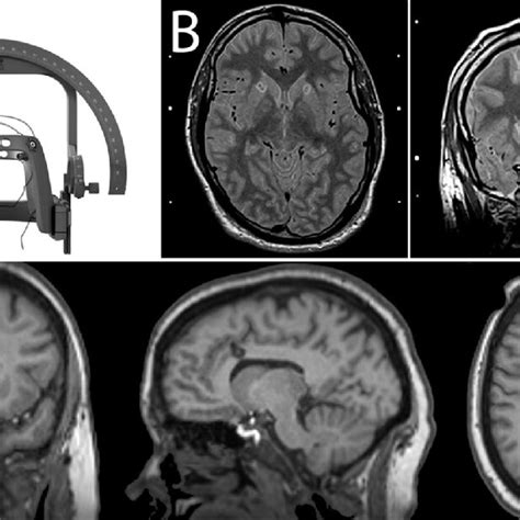 A Stereotactic Frames Use A Specific Coordinate System To Define And