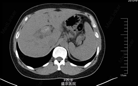 胆肠吻合术后肝内胆管结石
