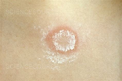Ringworm Stock Image Science Source Images