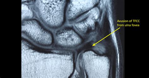Triangular Fibrocartilage Complex Mri