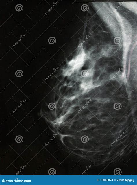 Kanker Van De Borst Stock Foto Image Of Radiologie Mammogram 13048074