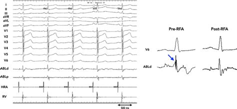 Surface Electrocardiogram And Intracardiac Electrogram After 35