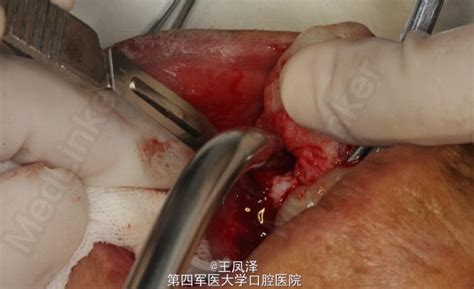 罕见巨大牙龈瘤一例 医联