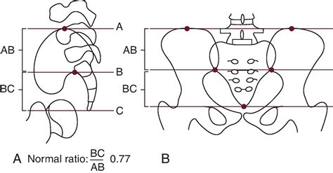 Congenital Anorectal Malformations And Hirschsprung Disease In The Neonate Clinical Tree