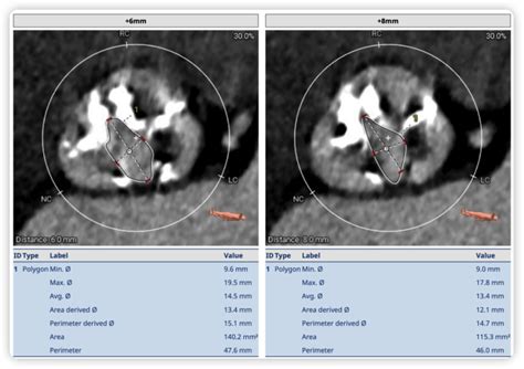 厦心医院成功完成全球首个polymer Tavr Sikeliaᵀᴹ高分子经股主动脉瓣介入置换系统的临床试验植入 严道医声网