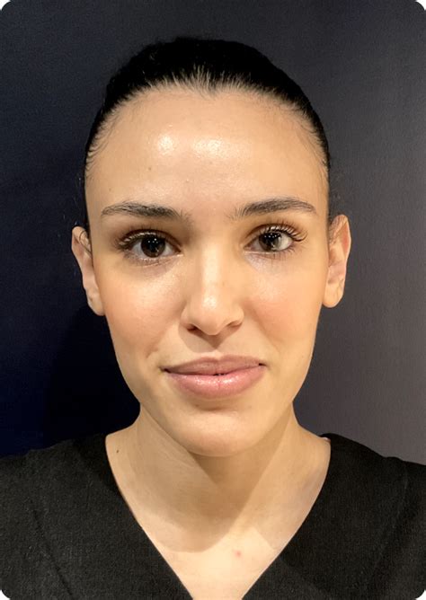 Botox For Eyelid Twitching And Blepharospasm London Harleystreet And Colindale