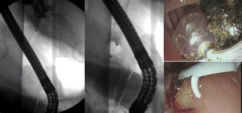 Razeeb Hassan On Linkedin Ercp Sphincterotomy And Stone Extraction Razeeb Hassan On Linkedin Ercp Sphincterotomy And Stone Extraction