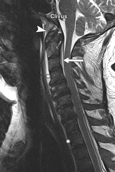 Retropharyngeal Abscess Radiology