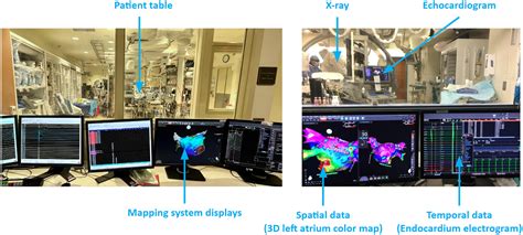 What Is Atrial Arrhythmia
