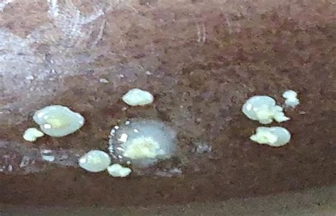 Molar Tooth Colonies Of Actinomyces Isrraelii On Chocolate Agar