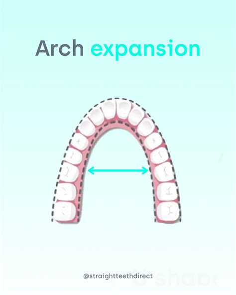 How To Get Straighter Teeth Without Interproximal Reduction Ipr