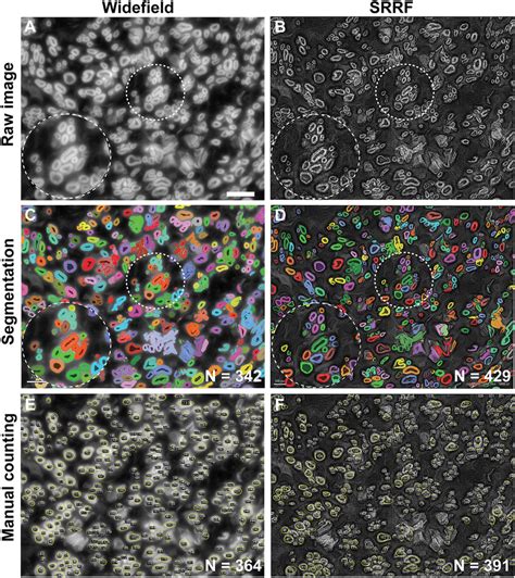 Super Resolution Imaging Of Regenerating Human Nerve Labelled With A