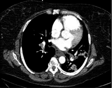 CT Angiography Large Burden Of Pulmonary Emboli In All Segmental And Download Scientific