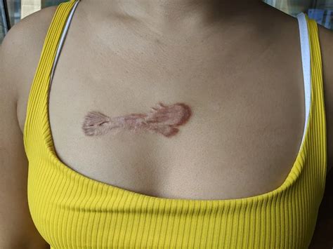 My Keloid Treatment Journey Using Kenalog Schimiggy Reviews